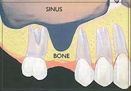 Dental Implants and Sinus Lifts Explained | Rye Smiles for Life